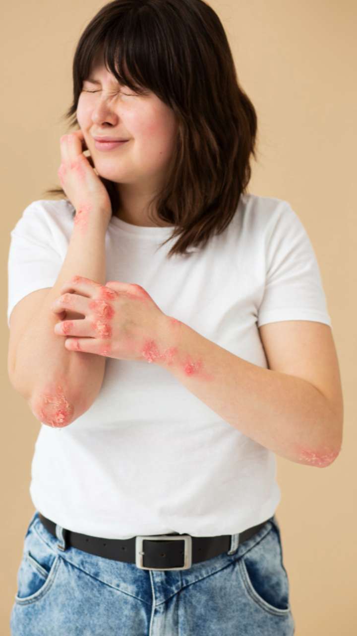 गीले कपड़े पहनने से रैशेज हो जाएं, तो कैसे ठीक करें?