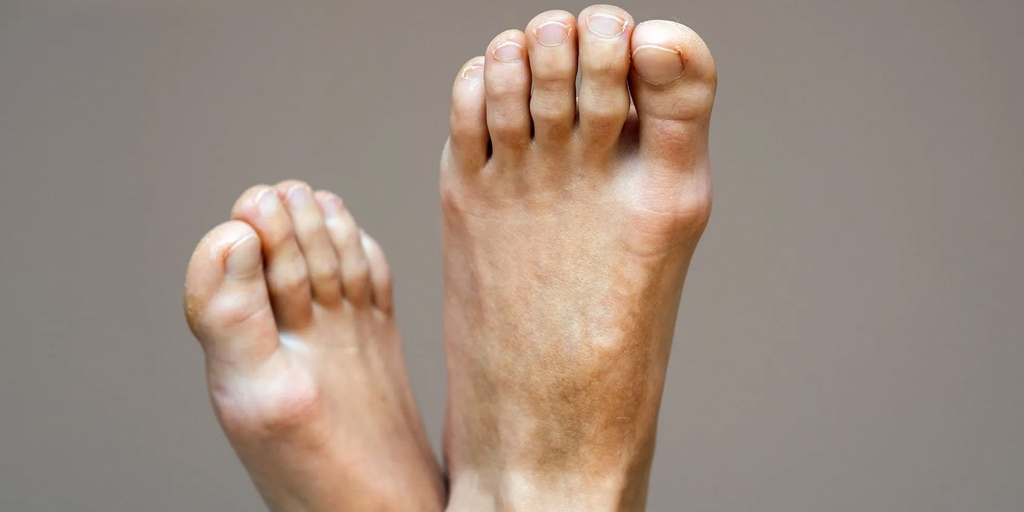 5 Remedies To Get Rid Of Foot Corn