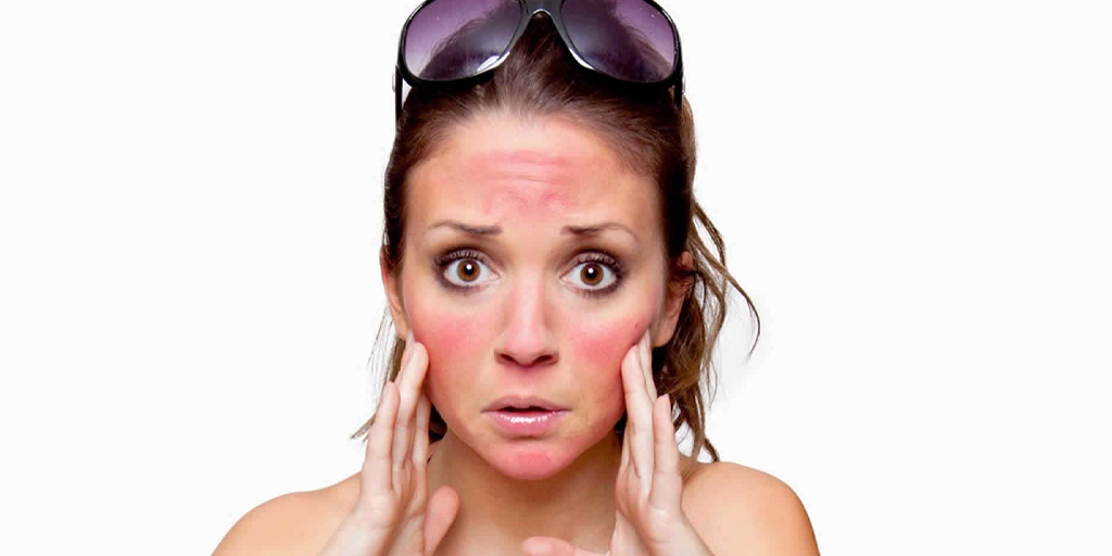 Symptoms Of Windburn