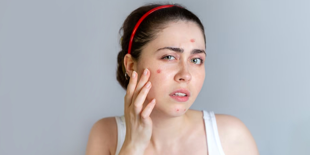 Things not to apply on face in hormonal acne